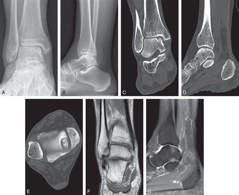 Osteochondral Lesions Clinical Tree