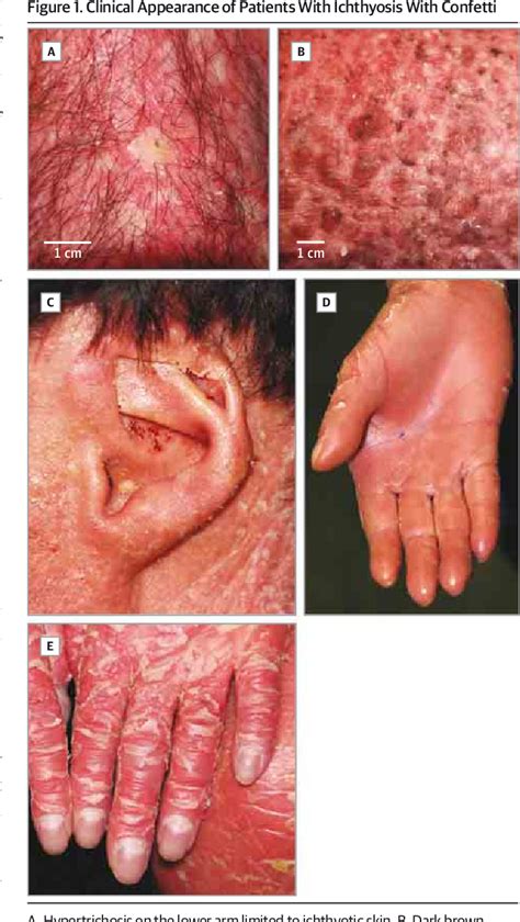 Figure 2 From The Phenotypic And Genotypic Spectra Of Ichthyosis With
