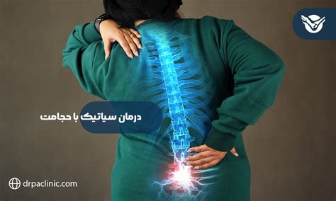 درمان سیاتیک با حجامت کلینیک تخصصی پا