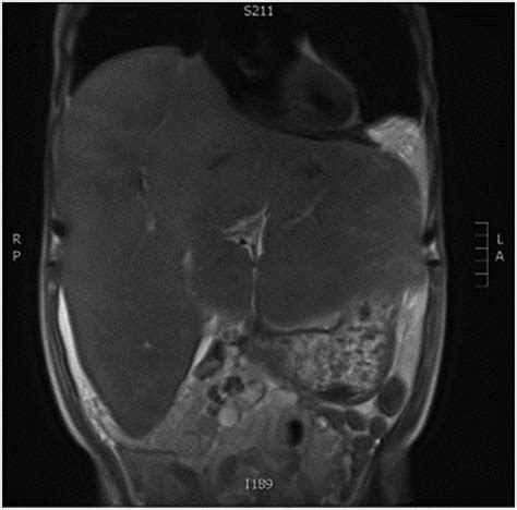 Magnetic Resonance Imaging Scan Showing Progressive Hepatomegaly