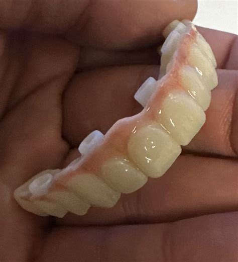 Implant Supported Dentures Houston Tx Smile 32 Dentistry