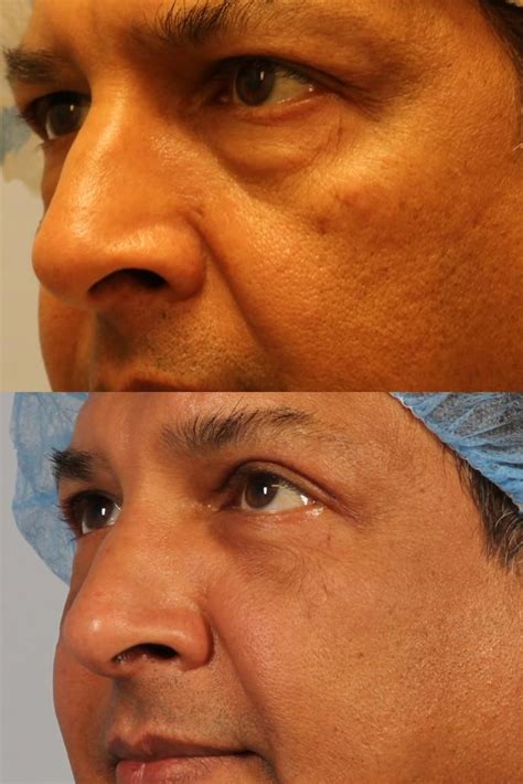 Dark Circleseye Bags Dr Brett Kotlus Cosmetic Oculoplastic Surgeon