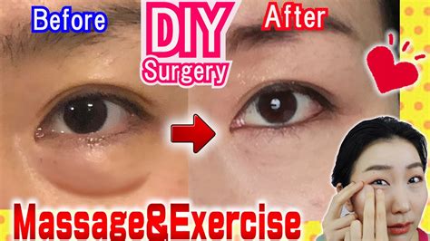 How To Remove Under Eye Bags👁️ Naturally In 7 Days Massage And Exercises🙋