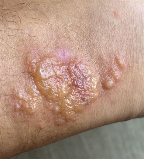 Cellulitis From Scratching Mosquito Bites Rmedicalgore