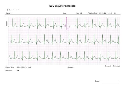 Compensatory Pause After Pvc R Askcardiology