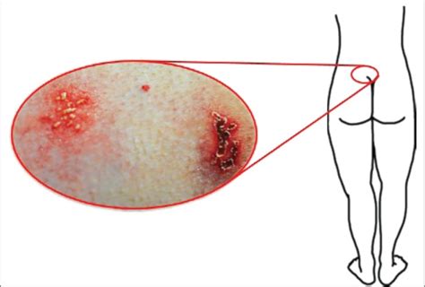 Recurrent Lumbosacral Herpes Simplex Virus Infection Pmc