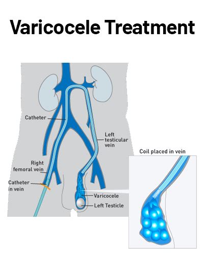 Varicocele Treatment In Jaipur Dr Amol Nagvekar