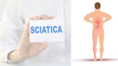 A Comprehensive Guide To Advanced Management Of Sciatica