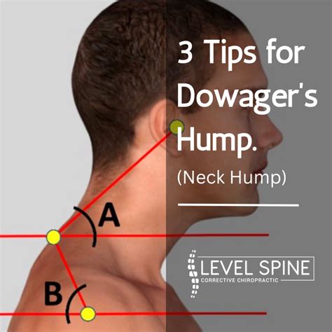 Fixing Neck Hump What Can I Do Getting Spines Healthy Again