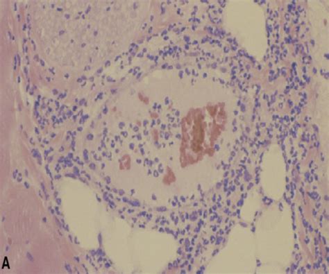 Lecture 30 Type Iii Hypersensitivity And Type Iv Hypersensitivity