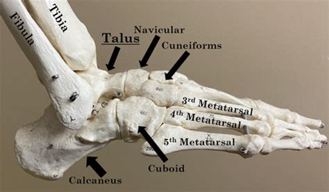 Talus Contusion