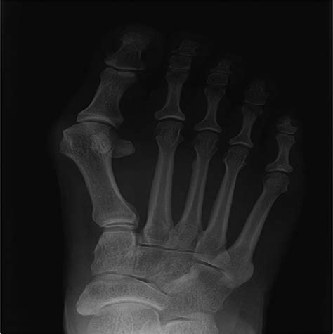 The Closing Base Wedge Osteotomy For Severe Hallux Valgus Techniques