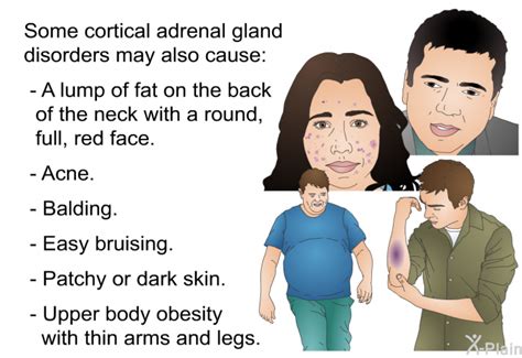 Cortical Adrenal Gland Disorders