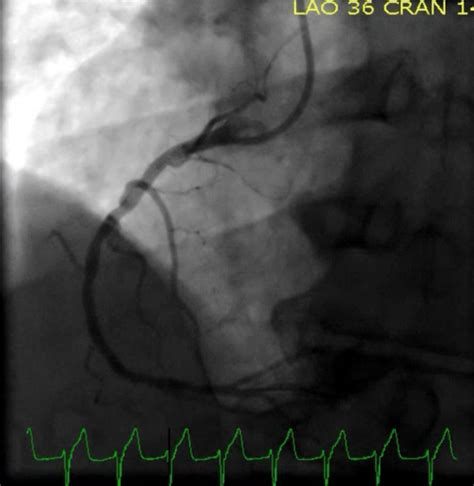 Dr Smith S ECG Blog Why Doesn T The Name OMI Say Anything About The ECG In Contrast To