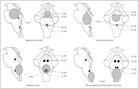 Mapping The Functional Integrity Of The Brainstem Bromedicon