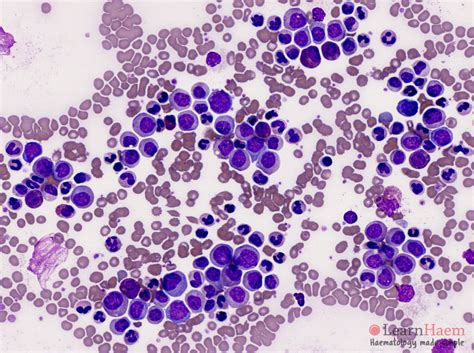 Chronic Myeloid Leukaemia Learnhaem Haematology Made Simple