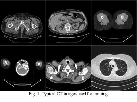 figure 3 from low dose ct denoising with convolutional neural network