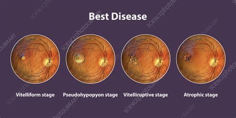 Stages Of Best Vitelliform Macular Dystrophy Illustration Stock