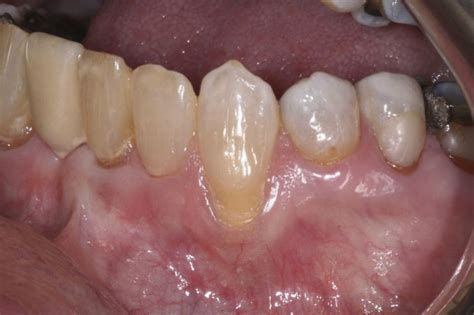 Treatment Of A Miller Class Ii Gingival Recession Defect June 2016