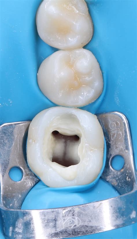 Rct For Lower 1st Molar Followed By Direct Composite Restoration Myzerodonto