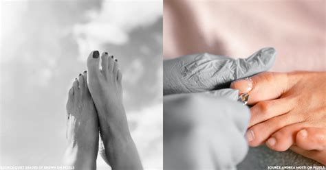 Tackling Toenail Troubles The Best Ingrown Toenail Treatments In Malaysia