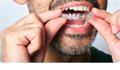 Should You Get A Retainer For Overbite