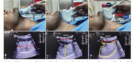 Figure 1 From Evaluation And Comparison Of Sonographic Difficult Airway