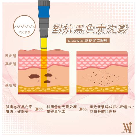 安穆美學診所 危肌警報 皮秒雷射，擊碎黑色素 對抗黑色素沈澱、除斑、嫩膚快、狠、準