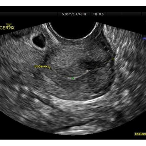 Transvaginal Sonography Completed In Case Report 1 That Demonstrated A