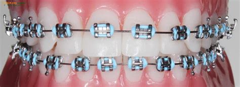Metal Braces 7 Key Benefits You Need To Know Dr Cuong Ho Chi Minh