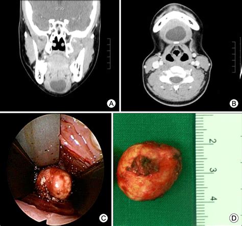 Figure 1 From Transoral Thyroglossal Duct Cyst Excision Semantic Scholar