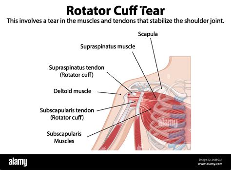 Detailed Anatomy Of Shoulder Rotator Cuff Tear Stock Vector Image Art