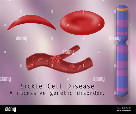 Sickle Cell Disease Is A Recessive Genetic Disorder An Illustration
