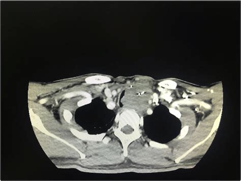 Axial View Of The Cect Neck Showing A Lobulated Hypodense Soft Tissue