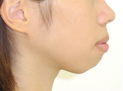 重度の口ゴボ、口唇閉鎖不全の治療例 【公式】日本橋はやし矯正歯科