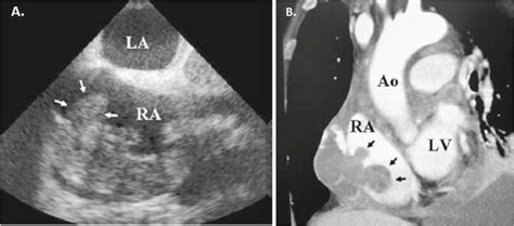 Cardiac Angiosarcoma Radiology Pdf Cardiac Angiosarcoma Heralded By