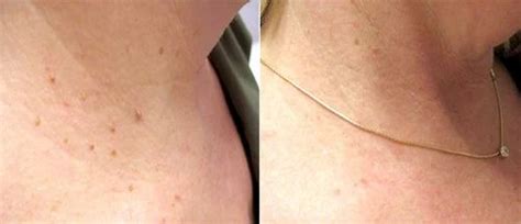 Nursing Homes Clinics Hospitals Of Mole Removal Wart Removal By Skin Laser Centre Noida