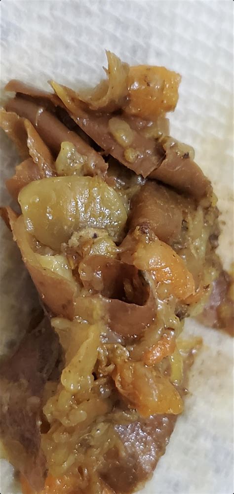 Dead Liver Flukes In Stool Rclinicalmicrobiology