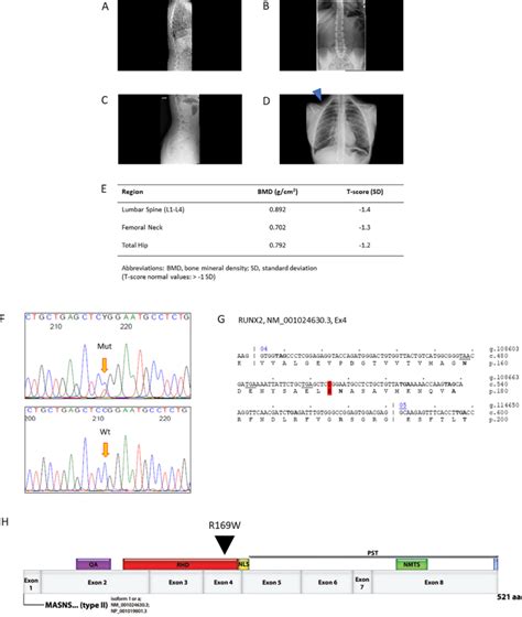 Unraveling Runx2 Mutation In A Cleidocranial Dysplasia Patient