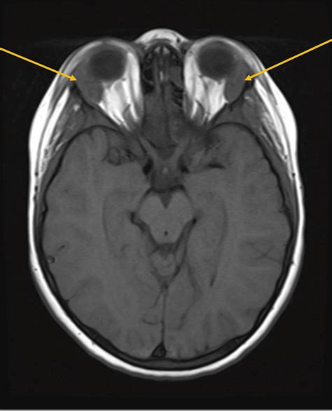 Axial T1 Weighted Mri Demonstrating Intermediate Signal Of The Orbital