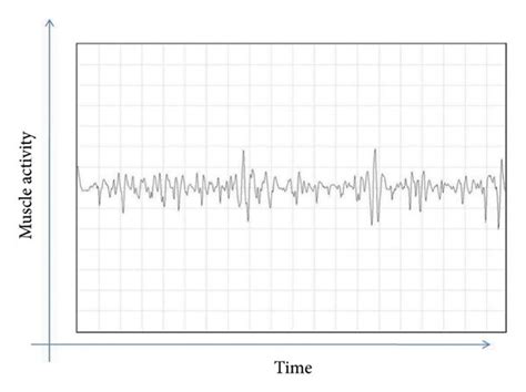 Electromyography Recording Of Osmf Patients Before Treatment