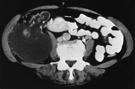 Us Scan Shows Multiple Cysts In The Right Abdomen The Internal Echoes