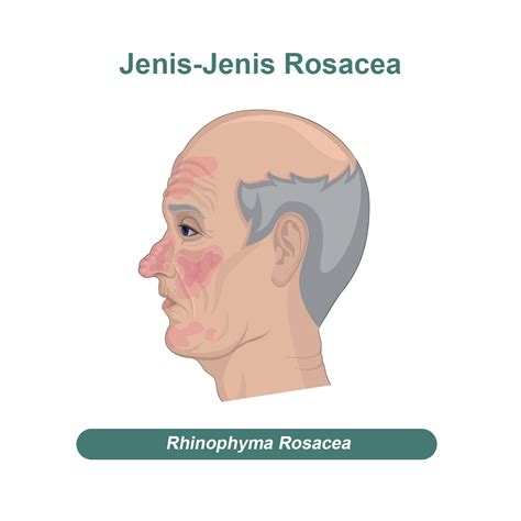 Rosacea Penyebab And Cara Menghilangkannya Heystetik