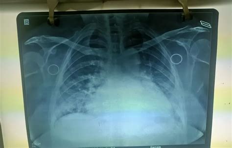 A 45 Year Old Female Experiencing Worsening Shortness Of Breath