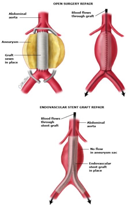 Abdominal Aortic Aneurysm Victorian Vascular
