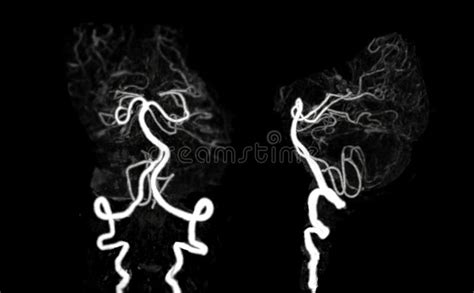 Ct Angiography Of The Brain Or Cta Brain Showing Noraml Cerebral Artery