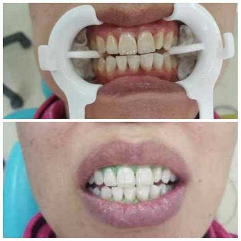 🤩🤩🤩Цасан цагаан шүдтэй болохыг хүсч Ami Dental Clinic