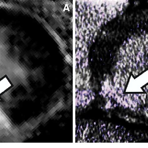 Cardiac Ct Study Of Acute Myocardial Infarction—first Pass Arterial