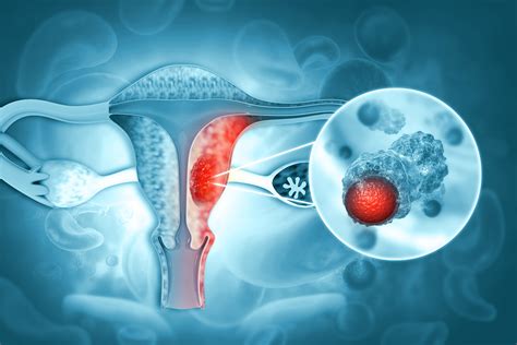 New Model Identifies Those At High Risk For Endometrial Cancer