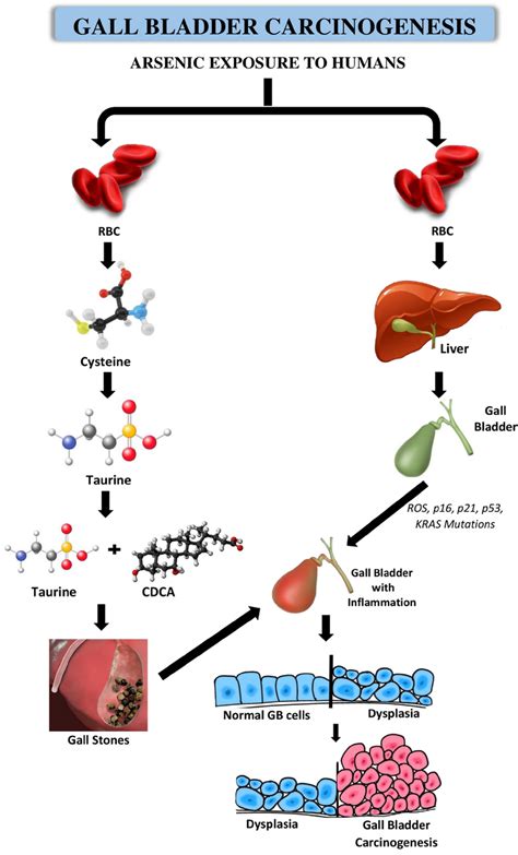 Schematic Diagram Showing The Etiology Of Gallbladder Carcinogenesis Download Scientific Diagram